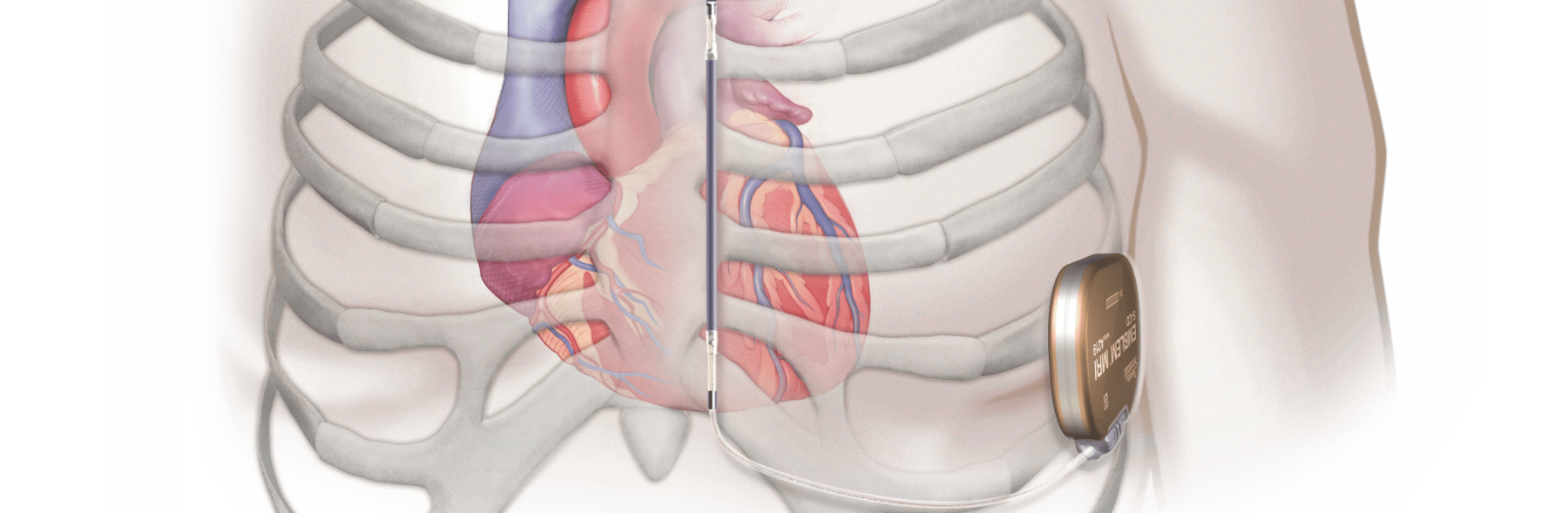 New cardiac defibrillator greatly reduced complications - News - PHRI