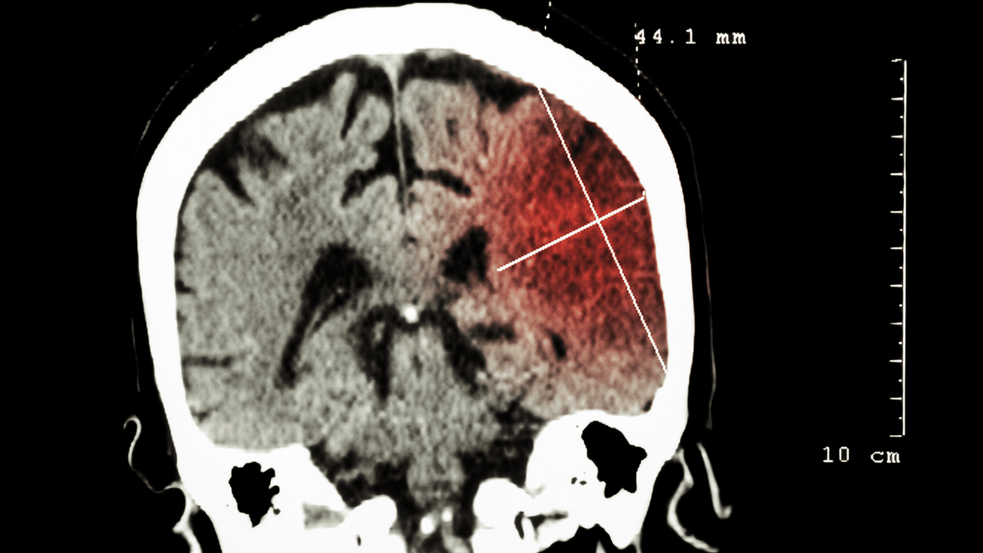 OCEANIC-STROKE reports promising topline results - News - PHRI